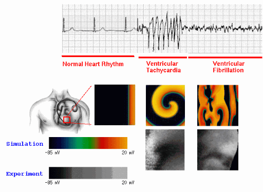 From plane Couette to arrest of cardiac arythmias?